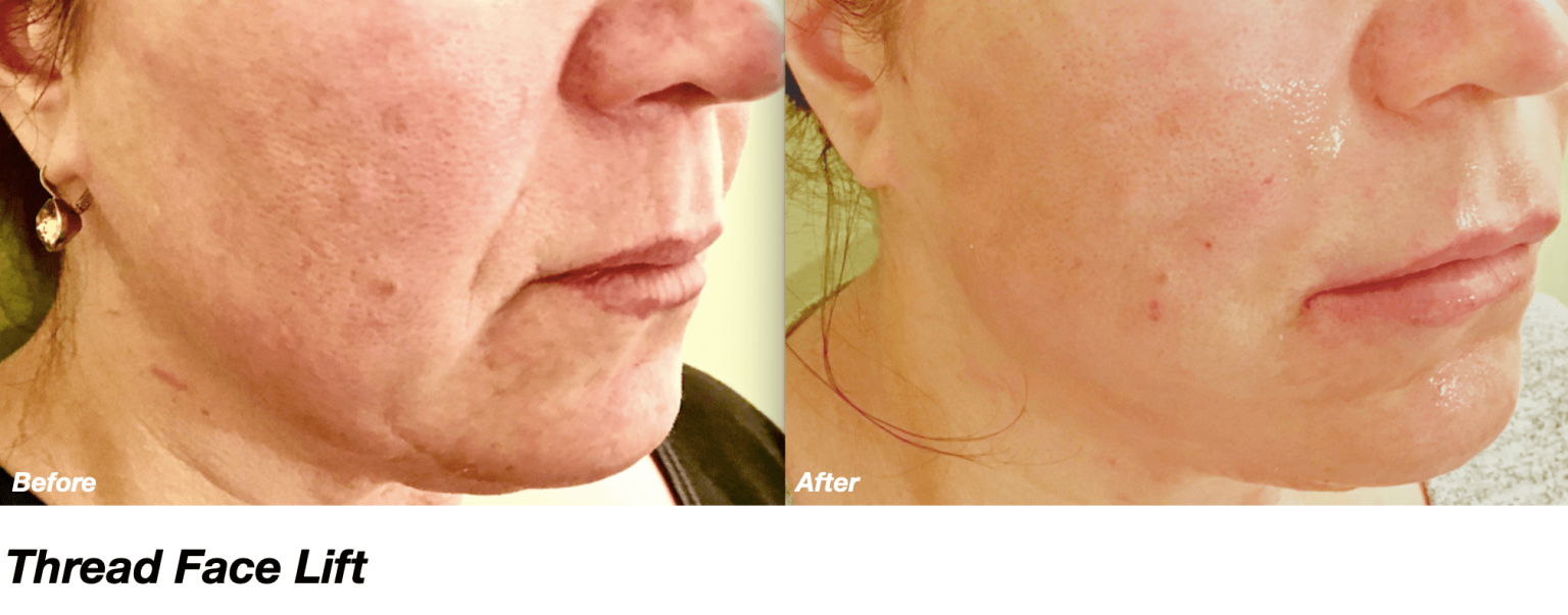 Face Thread-Lift in Vancouver | Dr. Mazanderani – Dr. Fazeli